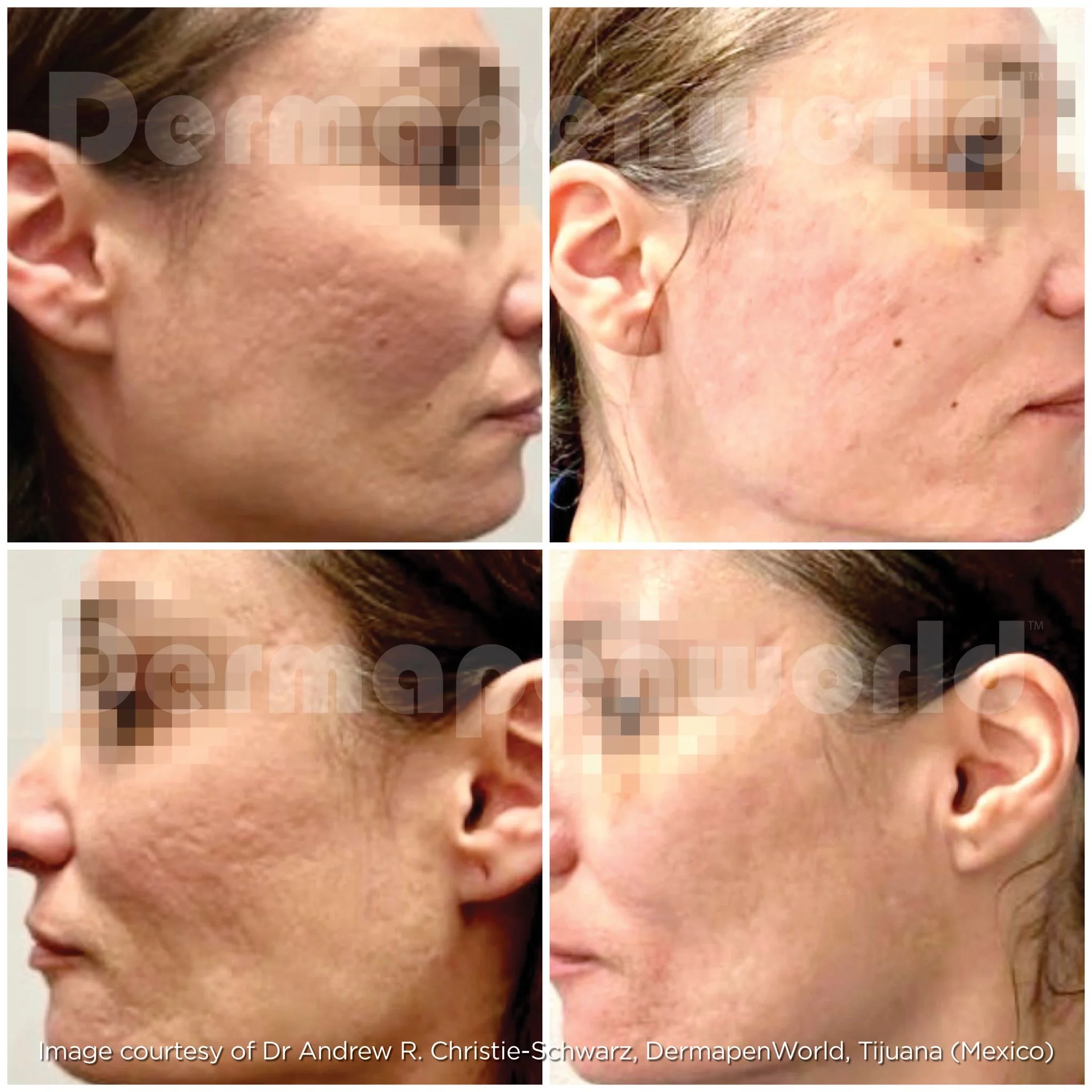 Dermapen 4 & Exosomes | Skin Perfection Dermapen 4 - Microneedling